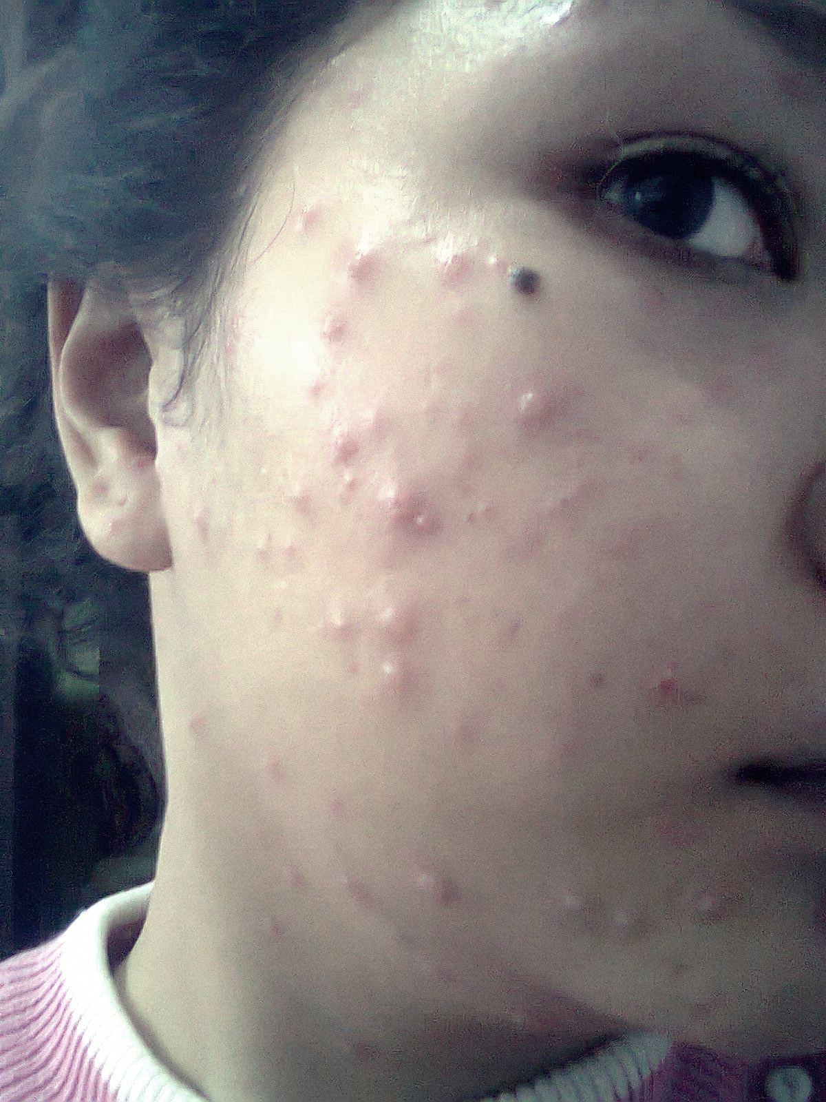 bulutong - philippin news collections