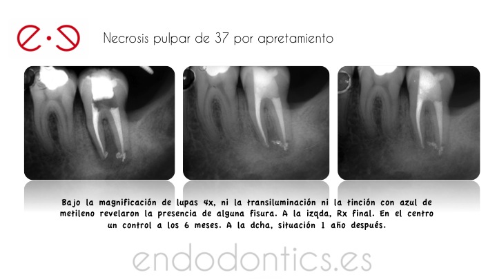 Endodoncia Microscópica en Zaragoza: Necrosis pulpar en 37 por ...
