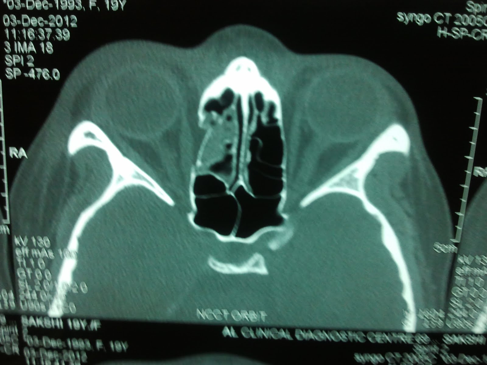 ENT Surgeon's blog: Isolated fracture of lamina papyracea.
