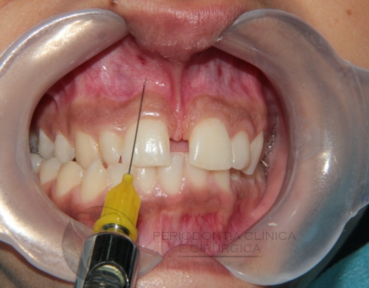 RELATO DE CASO: FRENECTOMIA LABIAL SUPERIOR COMO TRATAMENTO INICIAL PARA O FECHAMENTO DE ...