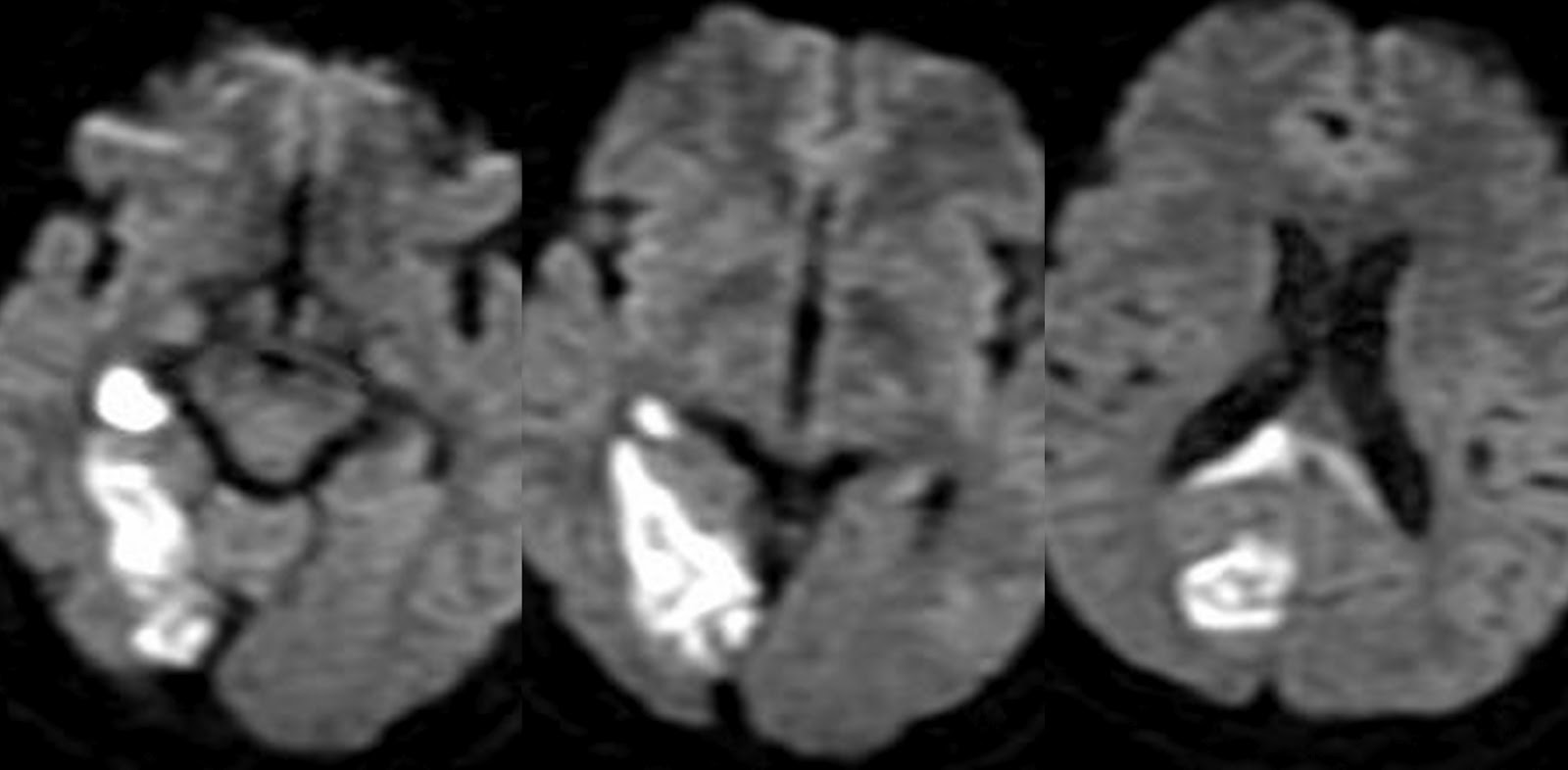 Dr Balaji Anvekar FRCR: Gyriform enhancement