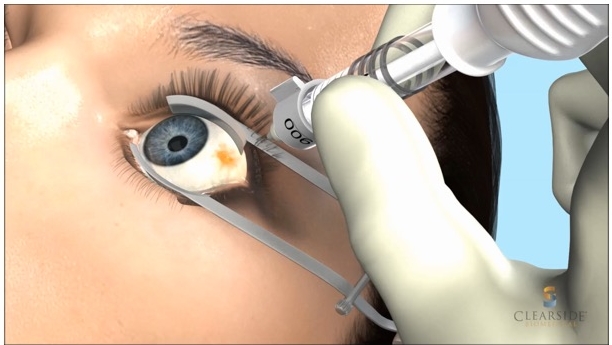 Recent Advancements in Optometry and Vision Science