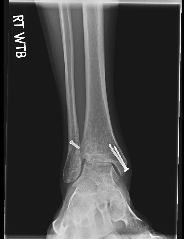 Two Broken Ankles: Getting ready for surgery