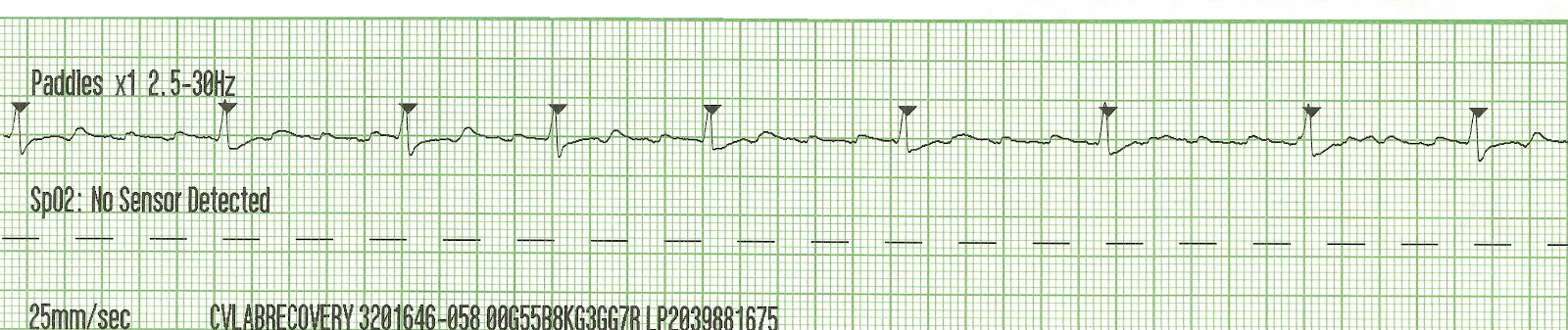 EKG Rhythm Strips 87: Cardioversion of Atrial Flutter