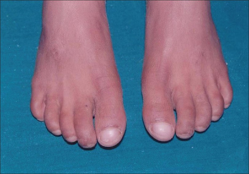 SUHASIS ONLINE: Ectodermal dysplasia with true anodontia