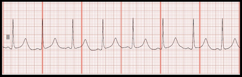EKG Rhythm Strip Quiz 147: Interval Measurements