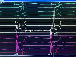 Dr Han Naung @ Henry Han : Electrophysiology and Heart Rhythm : EP Study