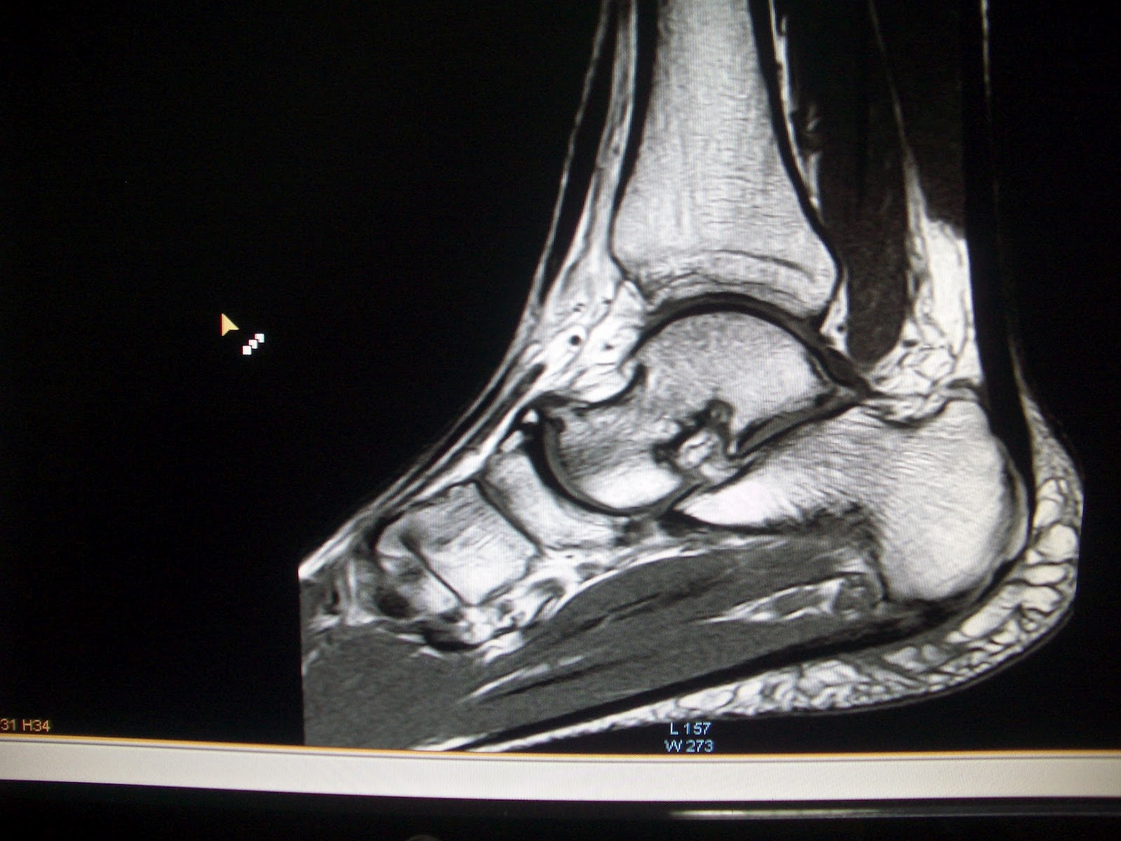 Podo Basas al Día: Fascitis plantar. Micosis intertriginosa. Papiloma ...