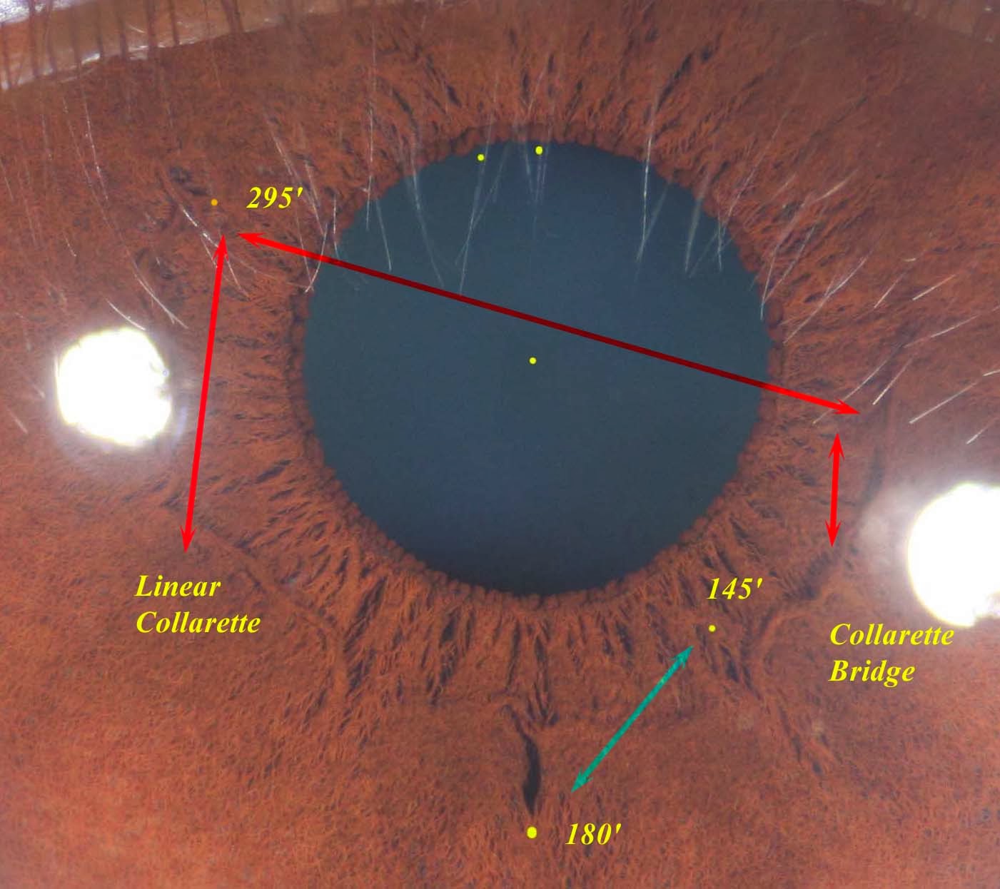 Modern & Multidimensional Iridology: Signs at Pupillary Zone, External ...