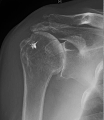 Shoulder Arthritis / Rotator Cuff Tears: causes of shoulder pain ...