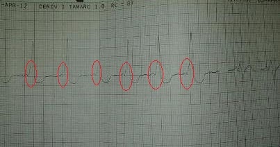 Electrocardiograma: Origen de la onda delta