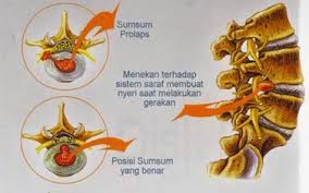 Mandiri Madani ( Terapi & Herbal ): Mengetahui Penyakit HNP/Saraf Kejepit