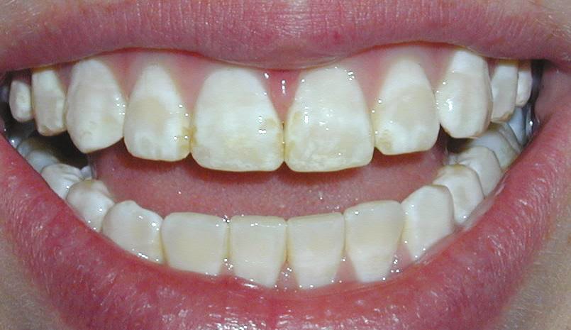 fluorosis
