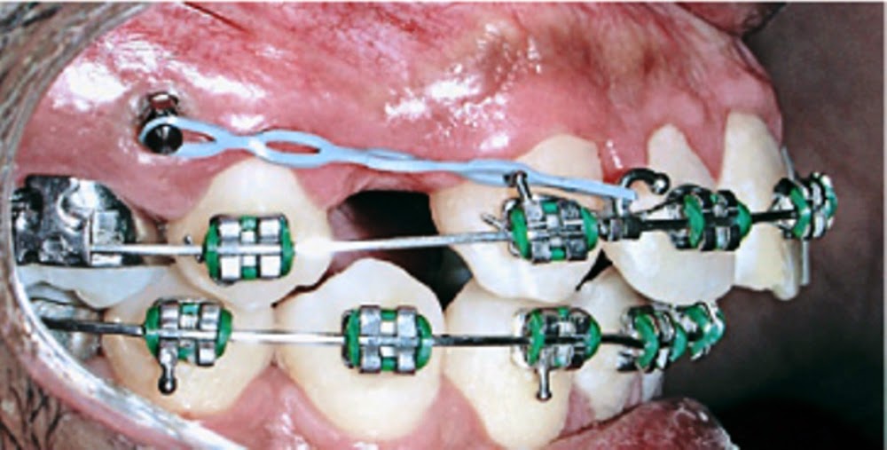 Blog do Mini-implante: ESPECIAL MINI-IMPLANTE: Protocolo: retração ...