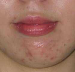 What Is Cystic Acne On Chin And How Do You Get Rid Of It ...