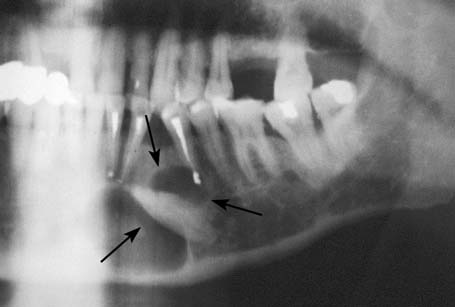 Dentistry and Medicine: Impacted Mandibular 3rd Molar Classification ...