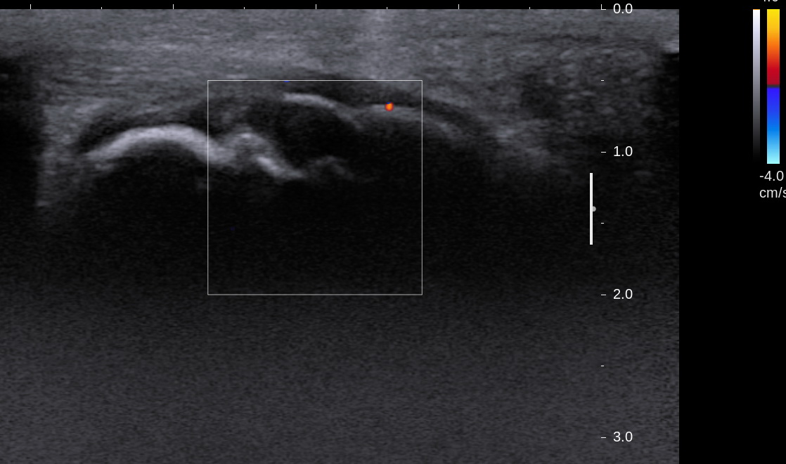 VIETNAMESE MEDIC ULTRASOUND: CASE 466:CHILDREN HEEL PAIN : A SEVER'S ...