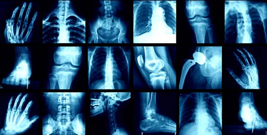 Hal-hal Yang Mempengaruhi Dalam Gambaran Radiografi - Zona Cafe Radiologi