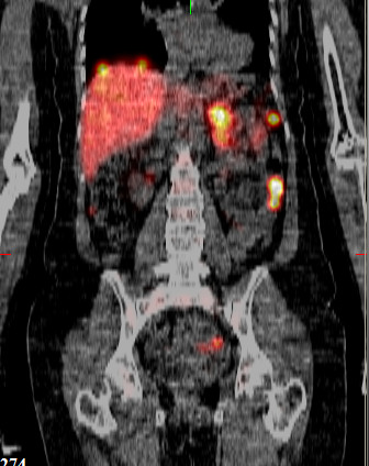 NuCleaR MuNkeE: Liver Spleen Scan Using Denatured Red Blood Cells