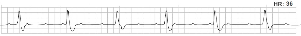 Learning ECG NSR WITH FIRST DEGREE AV BLOCK, SECOND DEGREE AV BLOCK ...