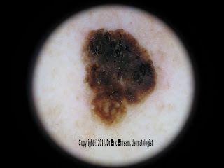 dermoscopy: Black lesion is back