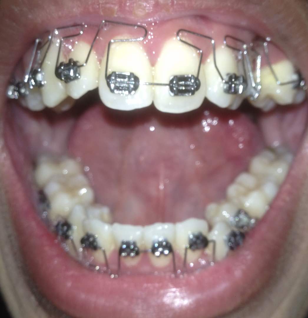 Sebelum dan Sesudah Memakai Behel Gigi - Monyoku