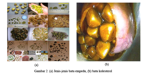 Alfian's Free Zone: MAKALAH KMB I KOLELITIASIS (Batu Kantung Empedu)
