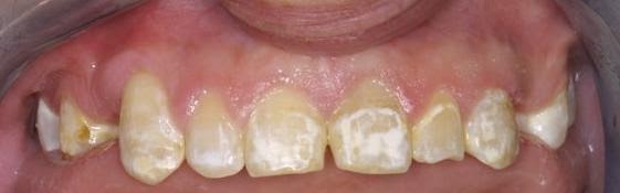 Omni Dental Group: Enamel Dysplasia