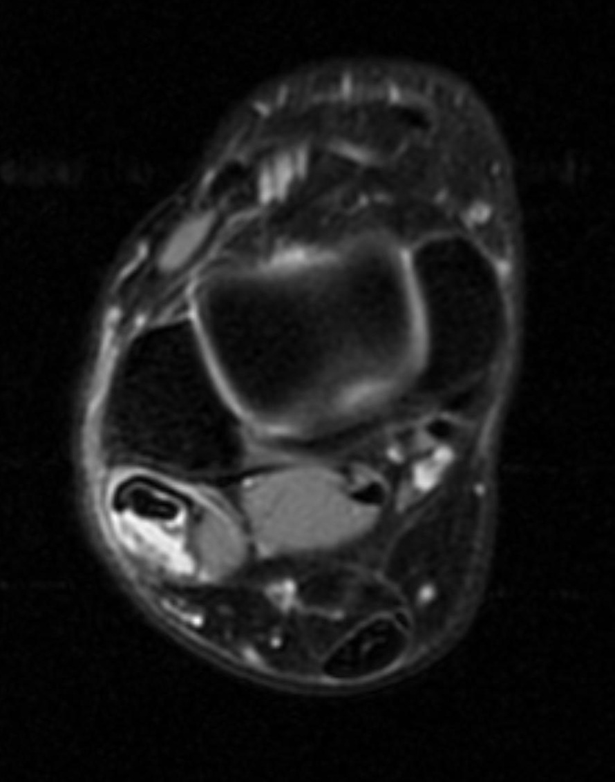 Split Peroneus Brevis Tendon-MRI - Sumer's Radiology Blog