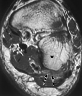 MRI Musculo-Skeletal Section: Peroneal tendon lesions.