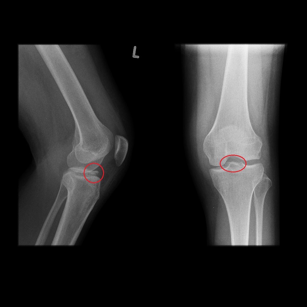 List 100 Pictures Pictures Of A Broken Knee Excellent