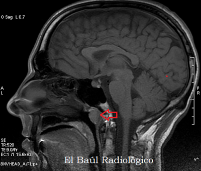 El Baúl Radiológico: QUISTE DE TORNWALDT. BURSA RINOFARÍNGEA (Tornwaldt ...