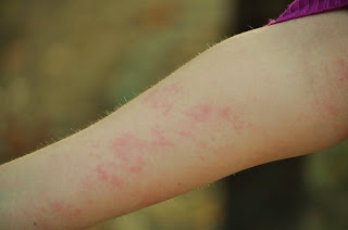 Beyond the Mirror: What Cold Induced Urticaria Looks Like