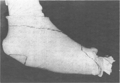 傷口大師: Off-loading 減壓-Scotchcast boot樹脂石膏鞋