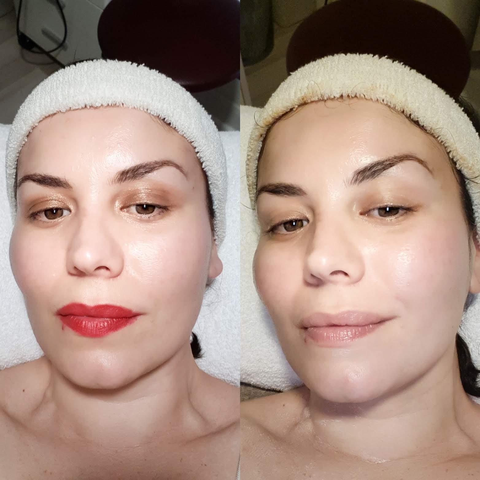 Remodeling Face con Asestetic