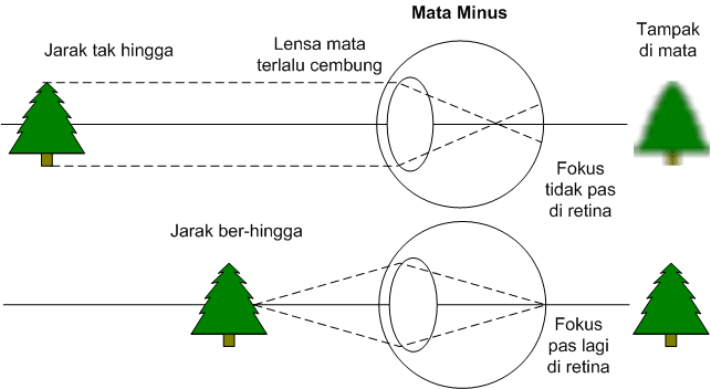 Mengenal Gejala Mata Miopi | Tips Pola Hidup Sehat Yang Benar