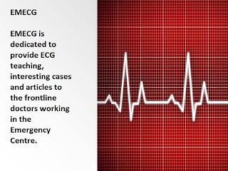 ECG Basics...the scribbles explained - Emergency Medicine Kenya Foundation
