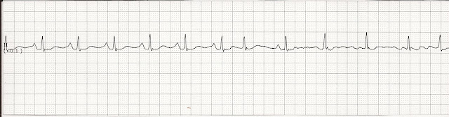 EKG Rhythm Strip Quiz 5