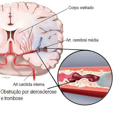 Liga Acadêmica de Neurologia e Neurocirurgia da UFPB: AVC por Artur ...
