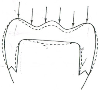 Dental Dreamz: Forces Acting on Restorations- A Seminar