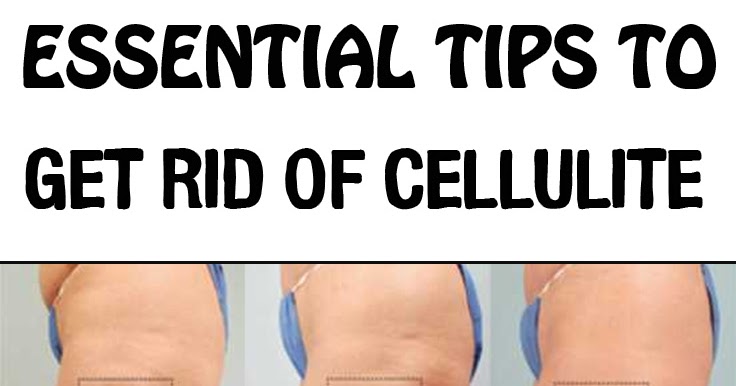 Essential tips to get rid of cellulite - Health Tips And Trick