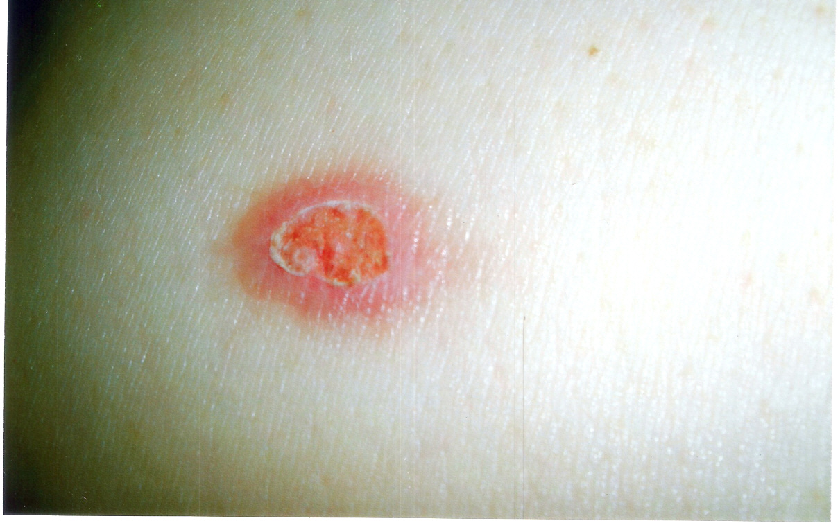 DANGERS OF PEDICLE SCREWS: SPINAL IMPLANT ALLERGIC REACTION OR REJECTION?