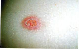 DANGERS OF PEDICLE SCREWS: SPINAL IMPLANT ALLERGIC REACTION OR REJECTION?