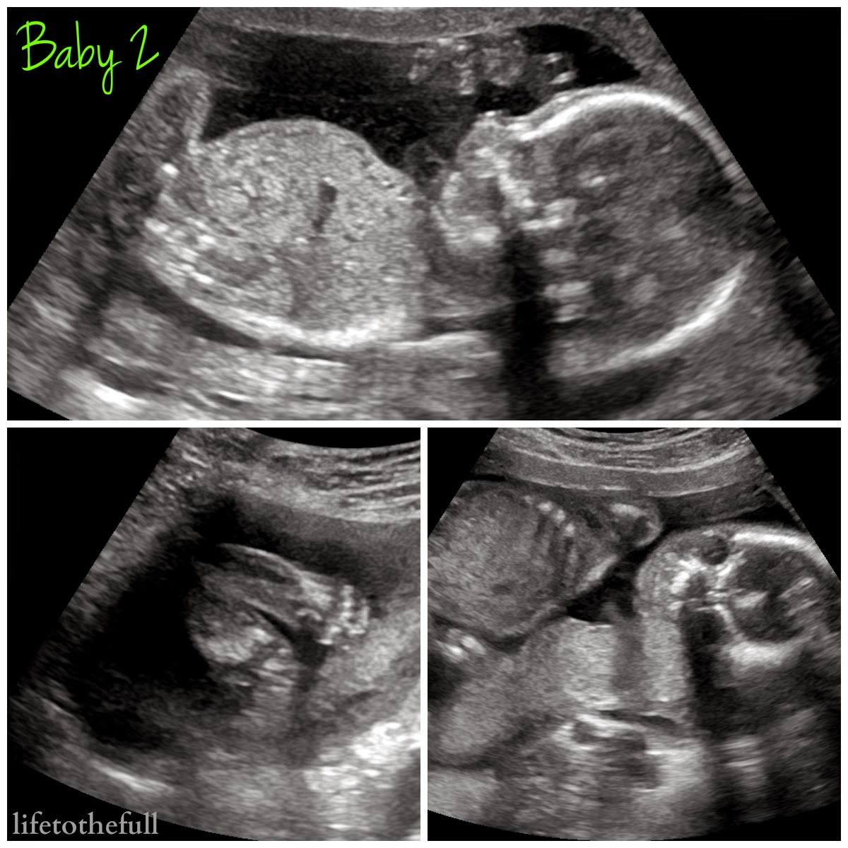 21 Week Ultrasound Profile