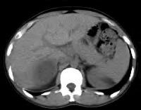 Abses Hepar Amuba | Tongkat Aesculapius