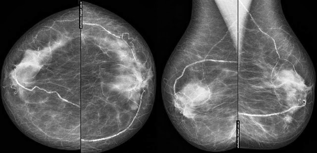 El esfenoides: BI-RADS 2. Calcificaciones vasculares bilaterales. 2 ...