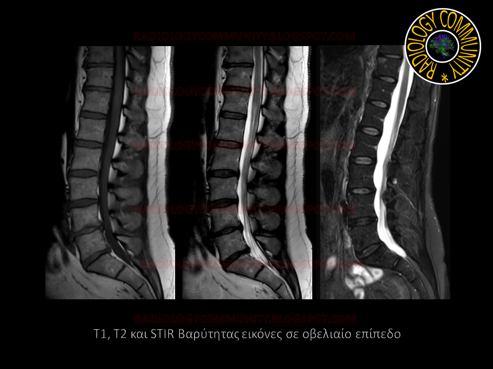 Radiology Community: Μαγνητική Τομογραφία Οσφυϊκής Μοίρας Σπονδυλικής ...