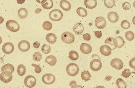 Medical Laboratory and Biomedical Science: Asplenic Patient