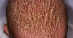 Farmacia Ortopedia Torrens : Costra láctea del bebé: ¿qué le pongo?