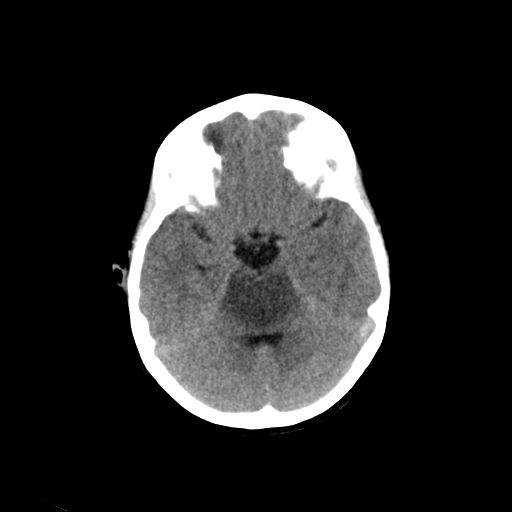 IRRADIATED - Radiology: DIFFUSE PONTINE GLIOMA